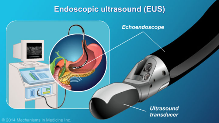 Understanding EUS-FNA