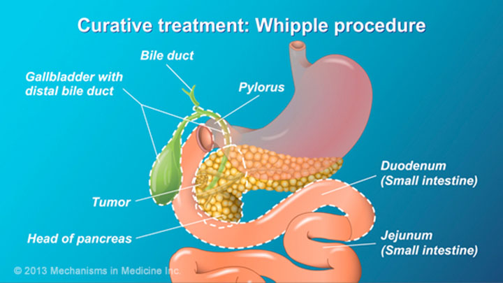 Whipple Procedure Animation