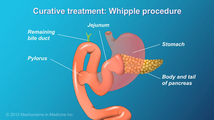 Whipple Procedure Animation