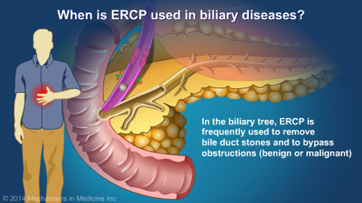 Understanding ERCP