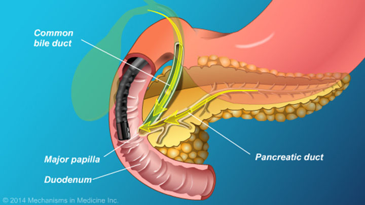 Understanding ERCP