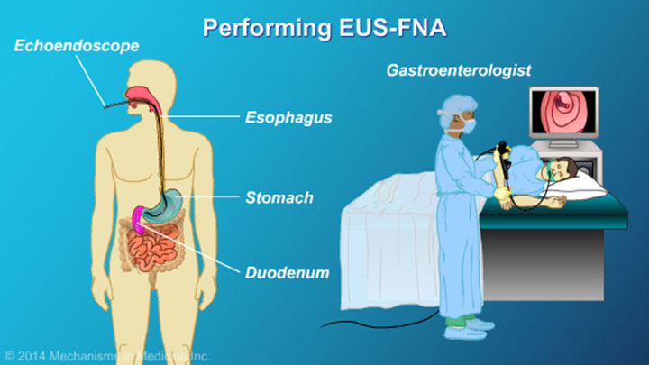 Understanding EUS-FNA