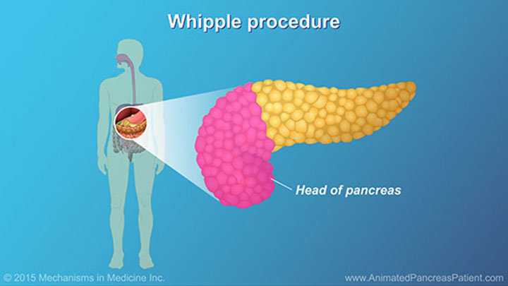 Whipple Procedure Animation