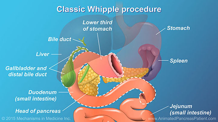 Whipple Procedure Animation