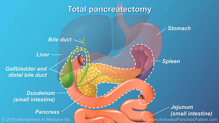 Total Pancreatectomy