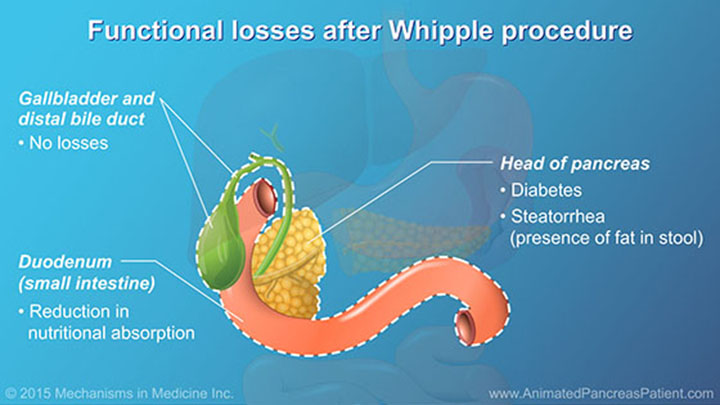 Whipple Procedure Animation
